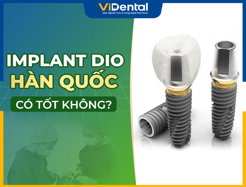 Trụ Implant Dio Hàn Quốc Có Tốt Hay Không? Giá Bao Nhiêu?
