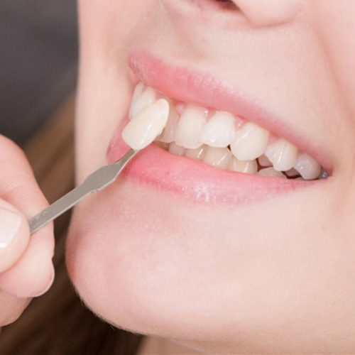 Răng Sứ Veneer: Ưu Nhược Điểm Và Quy Trình Thực Hiện